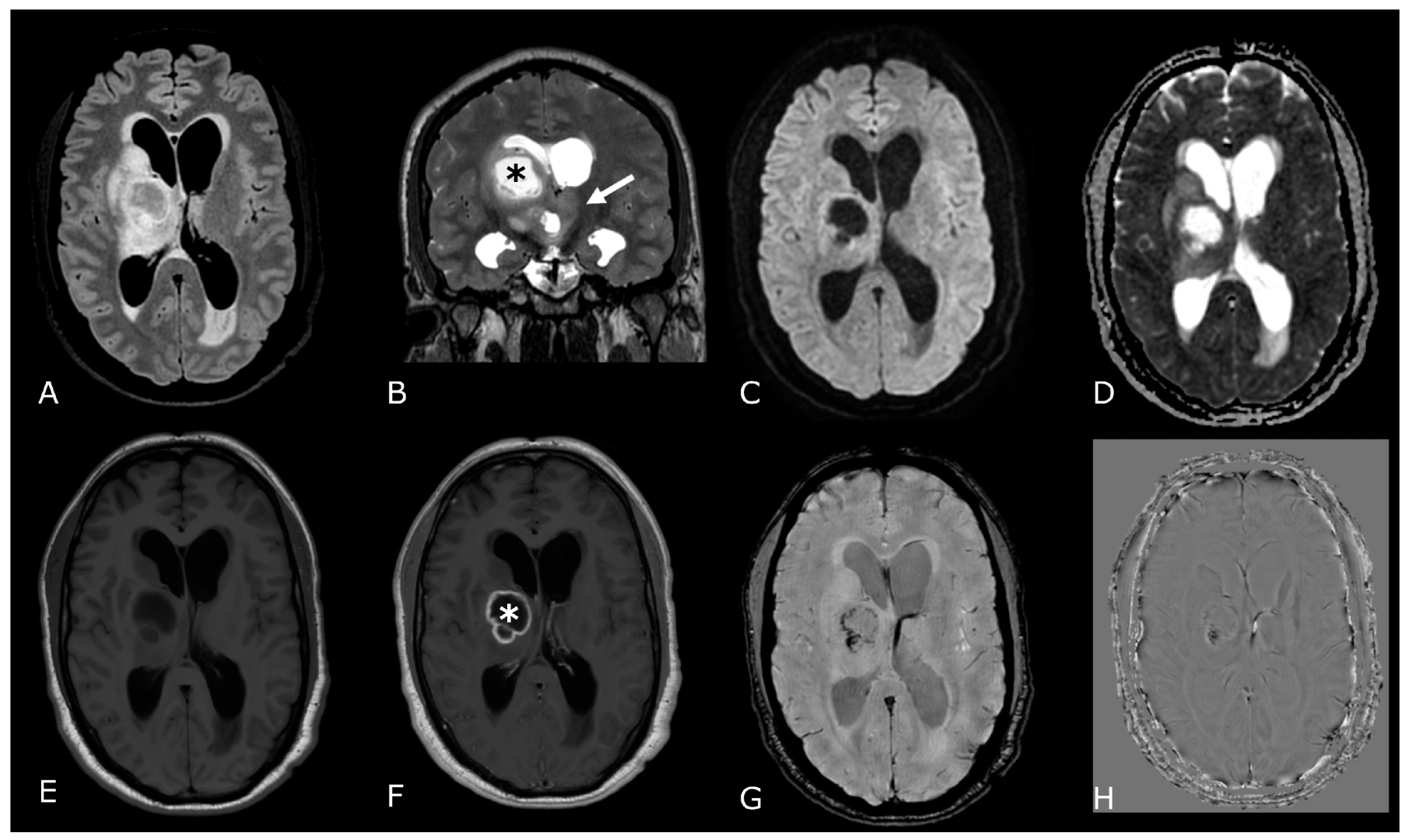 The Role of MRI in Neurosurgical Planning